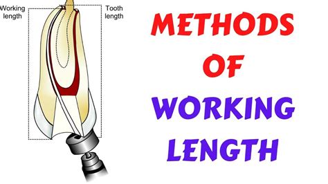 Endodontic Lecture Root Canal Procedure Method Of Working Length