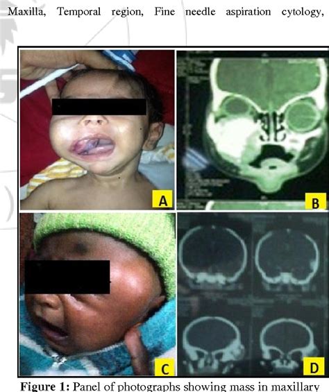 Figure 1 From Melanotic Neuroectodermal Tumor Of Infancy A Rare