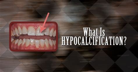 If Your Teeth Have White Spots Or Stains Your Tooth Enamel Could Be