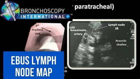 Ebus Lymph Node Map Nodal Anatomy Youtube