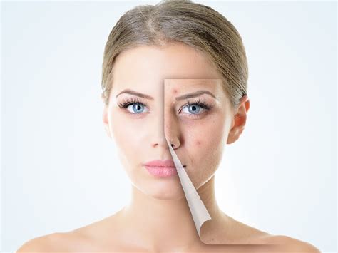 How To Remove Pimples From Your Face Clear Skin Secrets