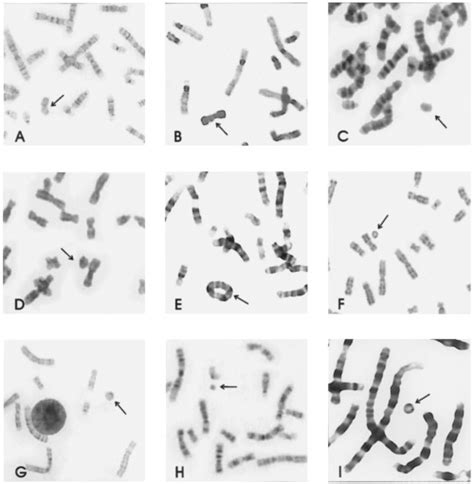 Partial Metaphases Showing Marker Chromosomes A And B Gtg And Cbg