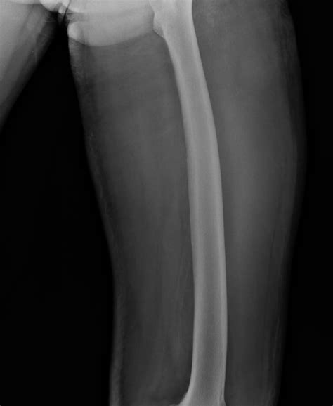 Tratamiento Fisioterapéutico Para Hematoma Por Golpe Efisio