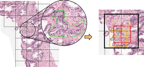 Schematic Diagram Of Intensively Sampling Left Small Cancerous