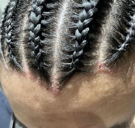 Small Red Bumps Along Hairline A Week After Getting Cornrows What Are