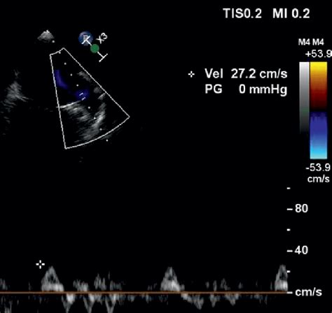 The Measurement Of Laa Fl Ow Velocity With Pulse Wave Doppler This Download Scientific Diagram