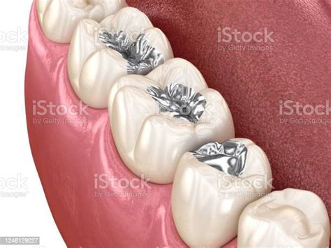 아말감 복원 치과 개념의 의학적으로 정확한 3d 애니메이션 건강관리와 의술에 대한 스톡 사진 및 기타 이미지 건강관리와 의술 금속 금이 간 Istock