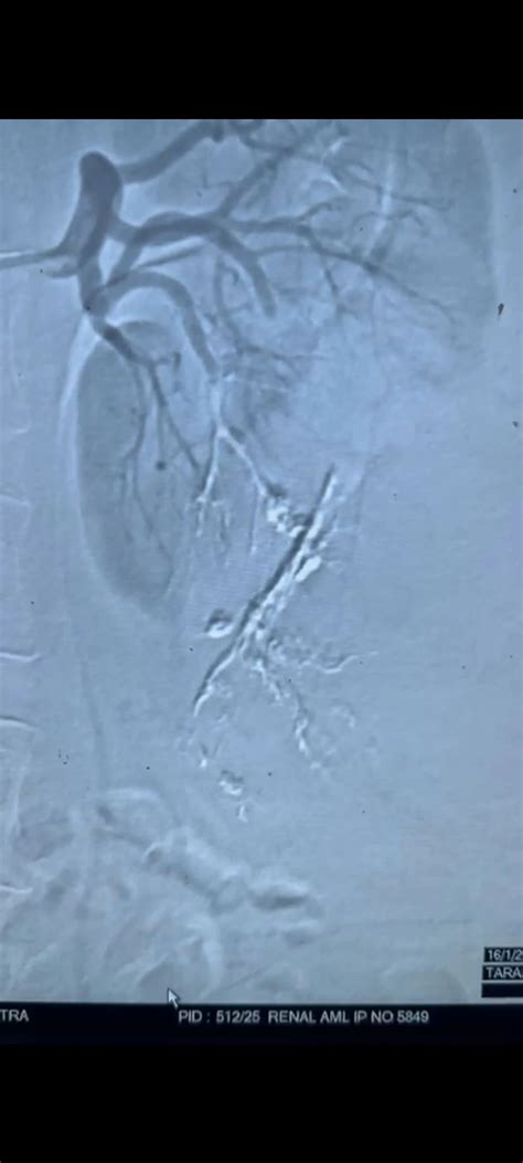 Case Of Ruptured Renal Aml With Psa Angio Embolization Done With 20 Nbca Glue Speedy