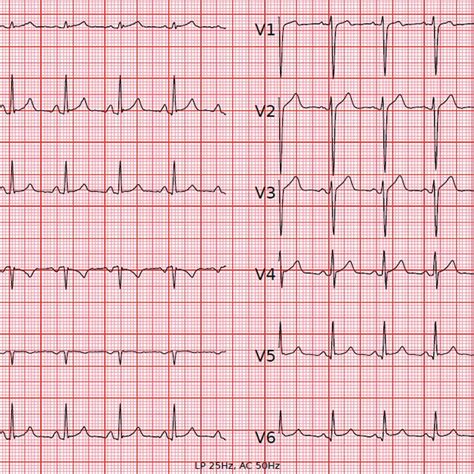Patient 2 Initial 12 Lead Ecg Showing A Sinus Rhythm At 64 Bpm With