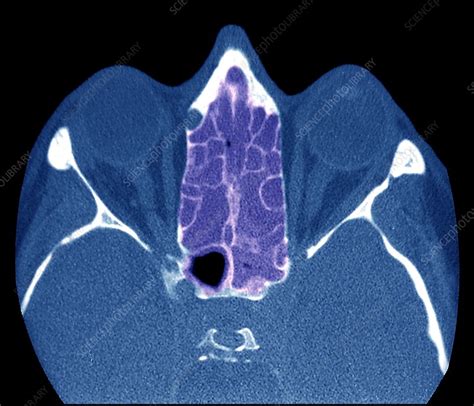 Ethmoid Sinus Infection Ct Scan Stock Image C0469127 Science