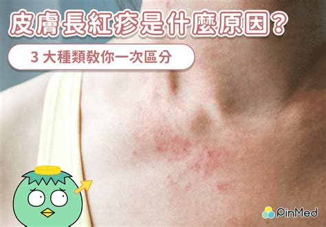 雞眼原來不會長手上？跟疣的差別在哪裡？想消除不能只靠治標方法 Pinmed