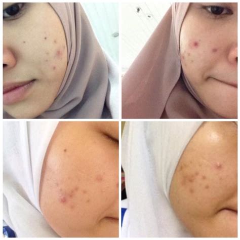 Rawat Kulit ‘breakout Dengan Produk ‘drugstore Pada Harga Berpatutan