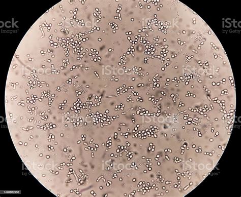 Budding Yeast Cells In Patient Urine Pyelonephritis Or Cystitis Analyze