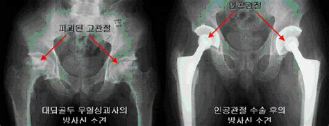 고관절 해부학 고관절질환 대퇴골두무혈성괴사의 진단법고관절대표 대퇴골두무혈성괴사의 원인 및 예방법 고관절인공관절수술 대퇴