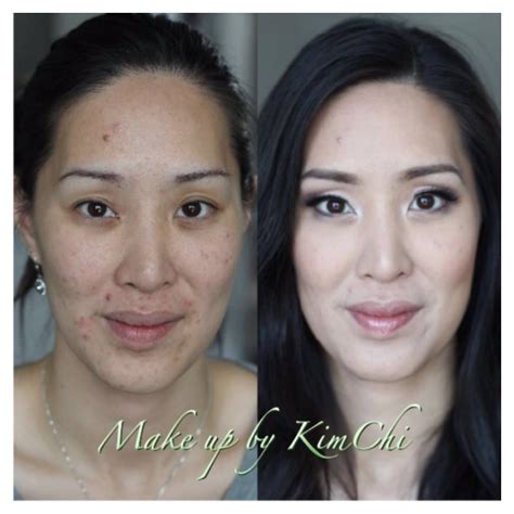 Acne Before And After Makeovers