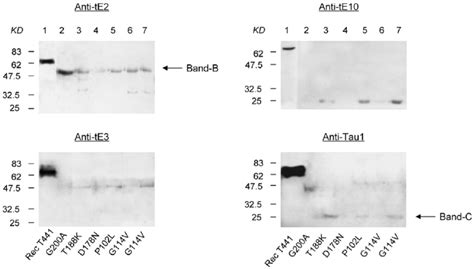 The Reactive Profiles Of Tau In Csf Samples From Six Gcjd Patients In