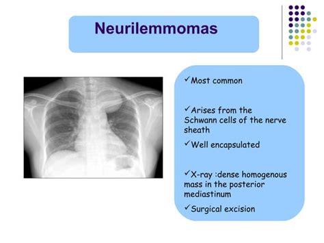 Mediastinal Tumours Ppt