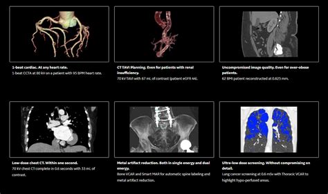 Introducing Our New Ge Apex Revolution Ct Synergy Radiology