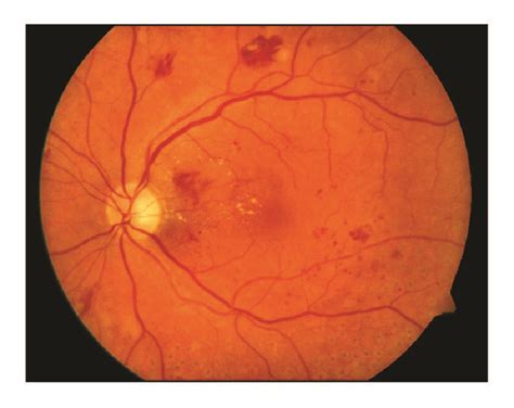 From Left To Right Original Rgb Color Retinal Images A And C Download Scientific Diagram