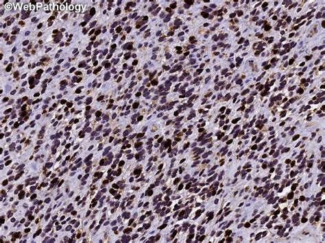 Embryonal Rhabdomyosarcoma Myogenin