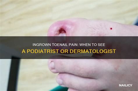 Ingrown Toenail Pain When To See A Podiatrist Or Dermatologist Nailicy