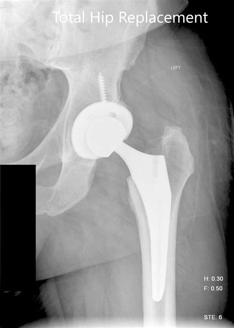 Case Study Left Hip Total Replacement In 54 Year Old Female