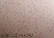 How To Get Rid Of Keratosis Pilaris Skinacea
