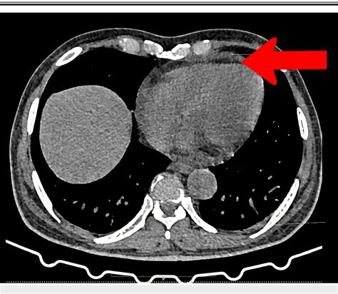 Figure 3 From A Rare Case Of Intravascular Large B Cell Lymphoma