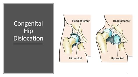 Congenital Hip Dysplasia