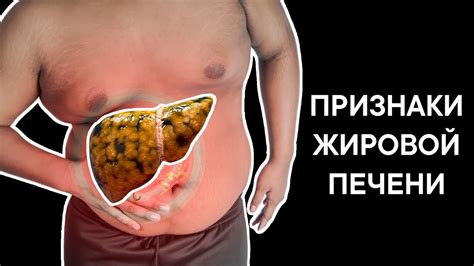 16 необычных признаков ЖИРОВОЙ ПЕЧЕНИ ПРОДУКТЫ для профилактики ГЕПАТОЗА Youtube