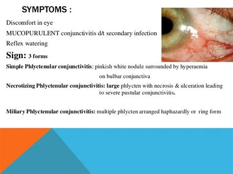 Allergic Conjunctivitis