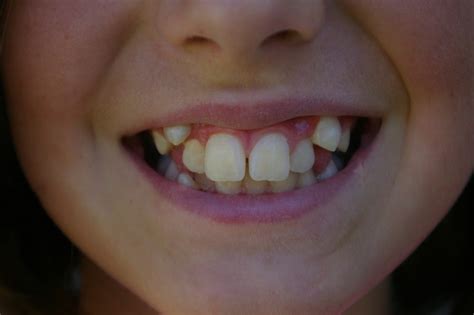 Overbite Vs Underbite What S The Difference Treatment