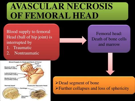 Avascular Necrosis Of Hip Avn Hip