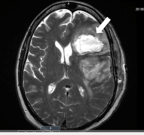 Mri Of The Brain Reveals Acute Left Posterior Frontal And Parietal