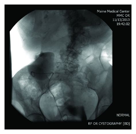 Right Retrograde Pyelogram Conducted The Following Day Indicating