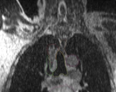 Structure Specific Rigid Dose Accumulation Dosimetric Analysis Of