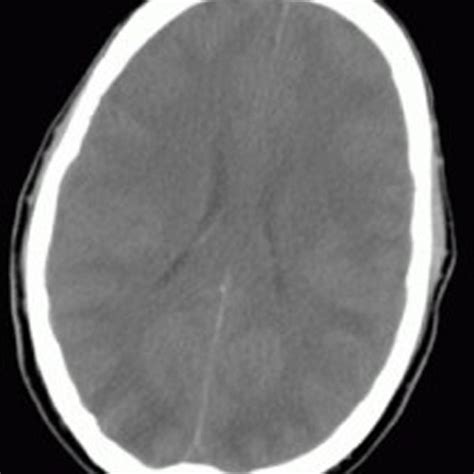 Non Contrast Computed Tomography Showing Diffuse Cerebral Edema