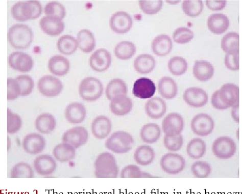 Hemoglobin E Semantic Scholar