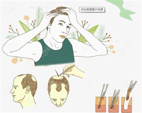 兰州植发专科医院排名除碧莲盛你还知道哪些正规植发机构上榜了 美佳社区