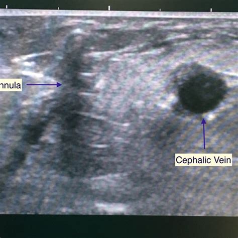 Pdf Ultrasound Guided Superficialization Of An Arteriovenous Fistula