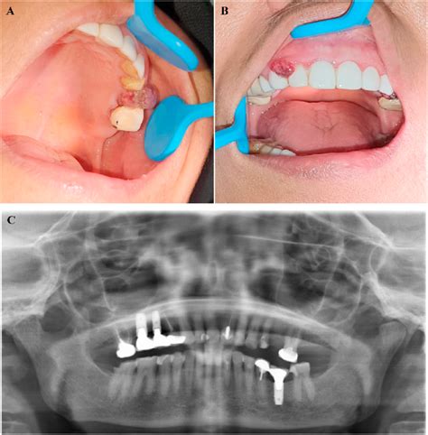 Initial Clinical Presentation Of The Lesions A Exophytic Pedunculated