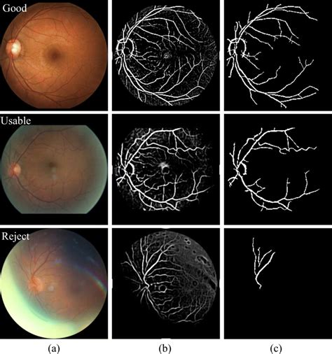 Examples For Detecting Tiny Size Salient Structures From Retinal Images