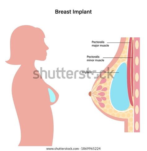 Breast Implant Female Silhouette Subfascial Placement Stock Vector