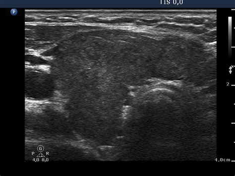 Chronic Lymphocytic Thyroiditis