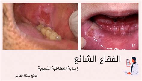 مرض الفقاع الشائع