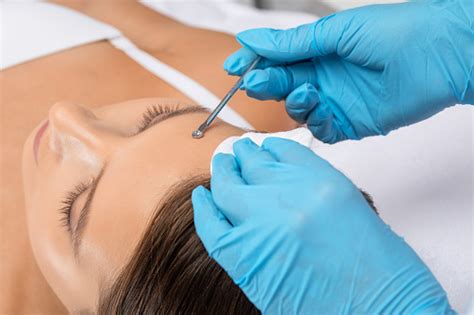 블랙 헤드와 여드름에서 얼굴의 피부를 정화하기위한 절차 미용실에서 미용실에서 젊은 여성의 얼굴의 문제가 있는 피부를 치료합니다 미용 미용 및 메이크업 컨셉 Carbuncle