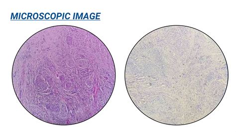 Granulomatous Orchitis Pptx