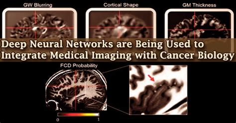 Deep Neural Networks Are Being Used To Integrate Medical Imaging With Cancer Biology