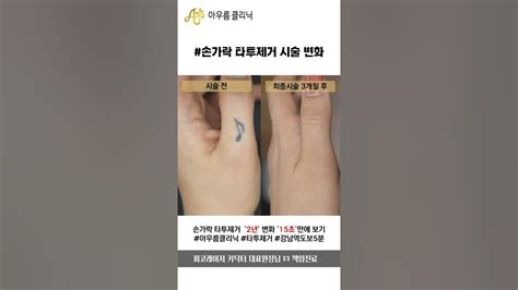 손가락 타투 제거 2년 변화 15초만에 보기 문신제거 타투제거 Youtube