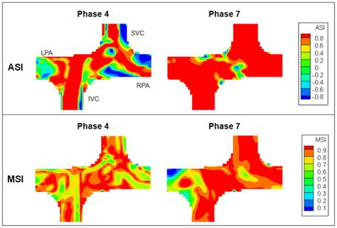 Numerical And Experimental Investigation Of Pulsatile Hemodynamics In The Total Cavopulmonary